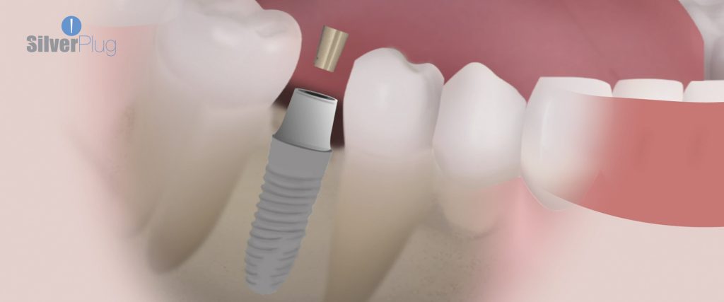 SilverPlug® – Silveraid – SilverPlug®