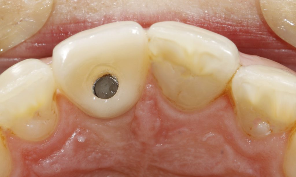 A great innovation for Dentists – Silveraid – SilverPlug®