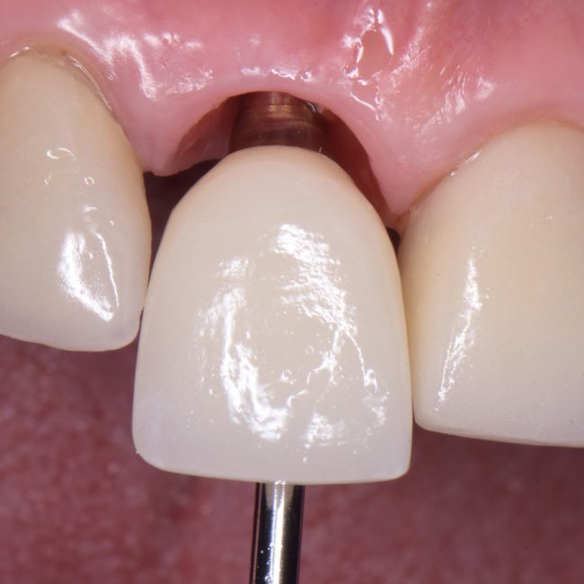 The use of SilverPlug® within a state-of-the-art implant placement case ...