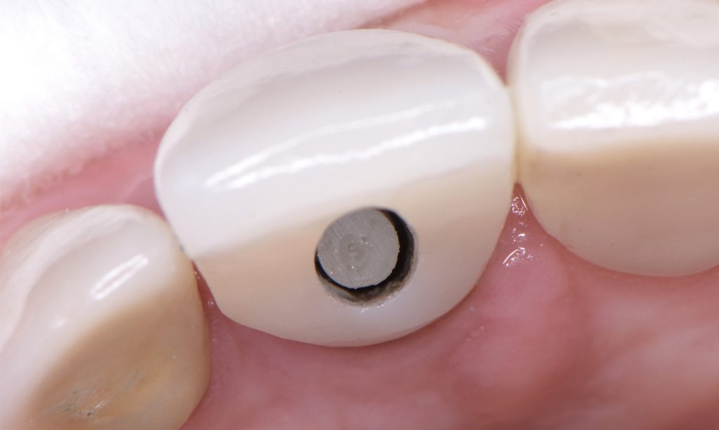 The use of SilverPlug® within a state-of-the-art implant placement case ...
