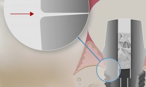 The Impact of Implant–Abutment Connection on Clinical Outcomes and ...